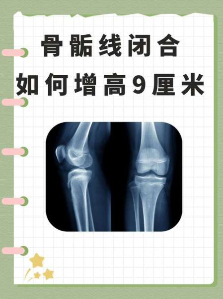 骨骺线闭合还能长高吗_骨骺线闭合增高9厘米是真的吗-第1张图片-山城妙识 骨骺线闭合还能长高吗_骨骺线闭合增高9厘米是真的吗-第1张图片-山城妙识