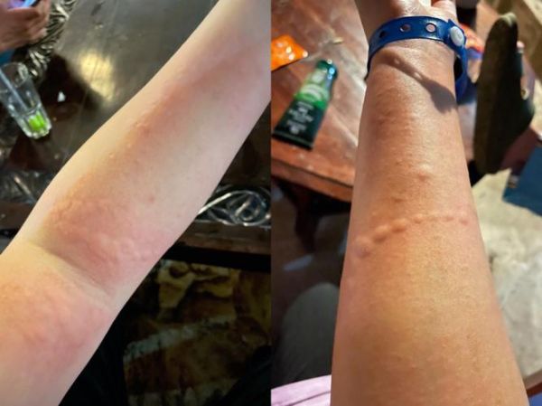 轻度水母蛰了伤口图片_怎么处理不留疤-第2张图片-山城妙识