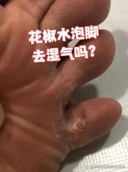 花椒水泡脚治脚气有效吗_花椒水泡脚的正确方法-第3张图片-山城妙识