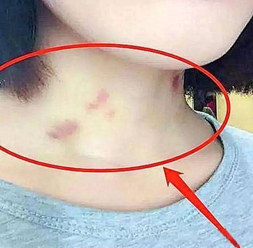 草莓印怎么吸_草莓印多久能消-第1张图片-山城妙识