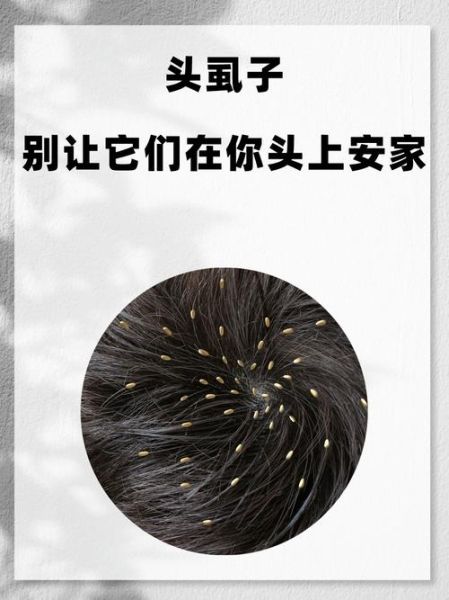 虱子怎么彻底去除_虱子卵如何识别-第3张图片-山城妙识 虱子怎么彻底去除_虱子卵如何识别-第3张图片-山城妙识