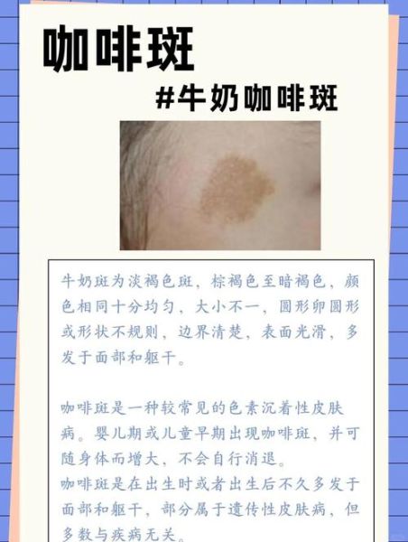 牛奶咖啡斑长什么样_牛奶咖啡斑和胎记区别-第1张图片-山城妙识