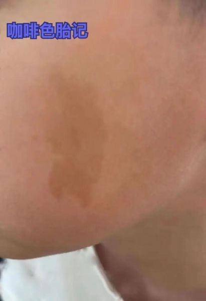 牛奶咖啡斑长什么样_牛奶咖啡斑和胎记区别-第3张图片-山城妙识