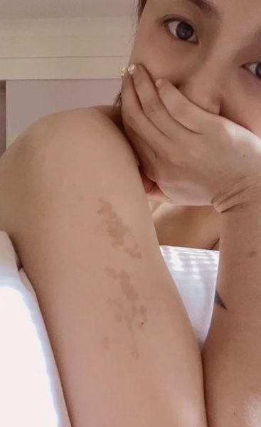 牛奶咖啡斑长什么样_牛奶咖啡斑和胎记区别-第2张图片-山城妙识