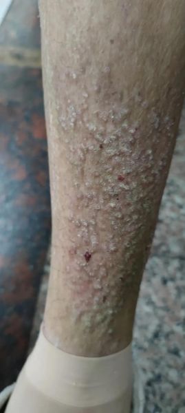 淀粉样变性是什么病_能活多久-第1张图片-山城妙识