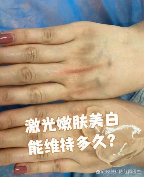 激光美白全身多少钱一次_效果能维持多久-第2张图片-山城妙识