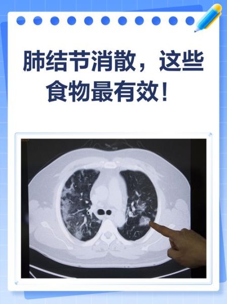 肺结节吃什么食物散结节最快_肺结节饮食禁忌有哪些-第3张图片-山城妙识