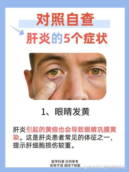 肝炎的症状有哪些_肝炎早期表现有哪些-第1张图片-山城妙识