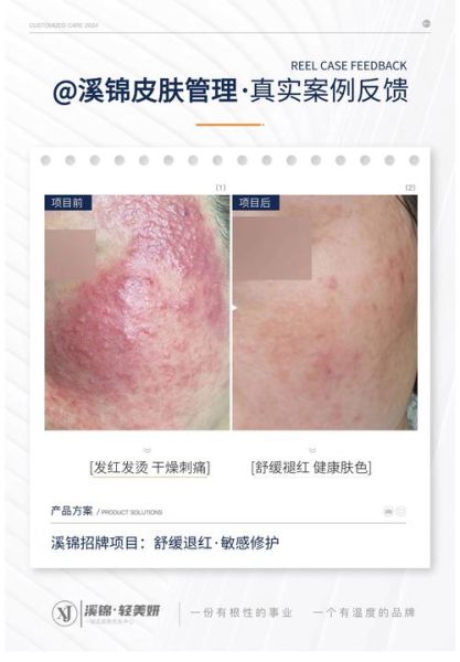 皮肤过敏自己会恢复吗_多久能好-第3张图片-山城妙识 皮肤过敏自己会恢复吗_多久能好-第3张图片-山城妙识