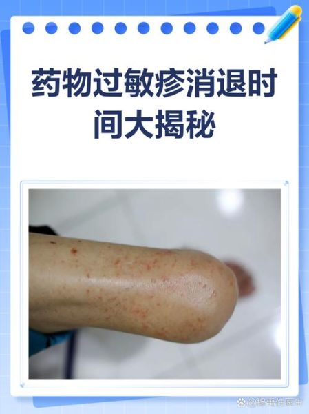 皮肤过敏自己会恢复吗_多久能好-第1张图片-山城妙识 皮肤过敏自己会恢复吗_多久能好-第1张图片-山城妙识