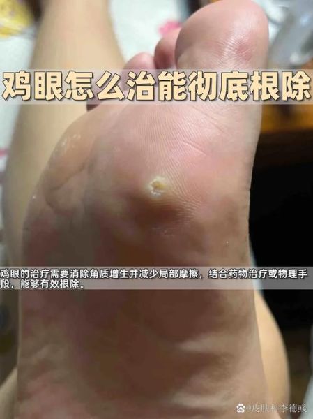 鸡眼怎么根治_鸡眼贴多久能好-第2张图片-山城妙识