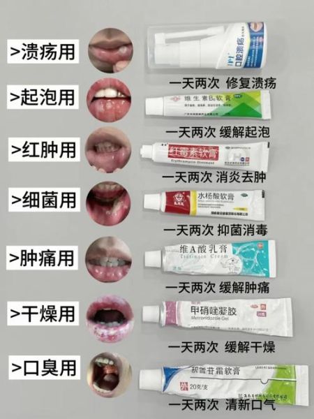 口腔溃疡怎么快速消除_口腔溃疡吃什么好得快-第1张图片-山城妙识 口腔溃疡怎么快速消除_口腔溃疡吃什么好得快-第1张图片-山城妙识