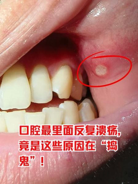 口腔溃疡长什么样_怎么判断是不是口腔溃疡-第1张图片-山城妙识 口腔溃疡长什么样_怎么判断是不是口腔溃疡-第1张图片-山城妙识