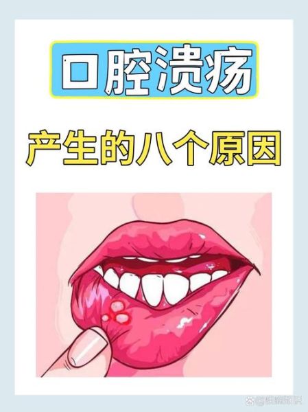 口腔溃疡长什么样_怎么判断是不是口腔溃疡-第2张图片-山城妙识 口腔溃疡长什么样_怎么判断是不是口腔溃疡-第2张图片-山城妙识