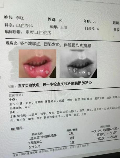 口腔溃疡长什么样_怎么判断是不是口腔溃疡-第3张图片-山城妙识 口腔溃疡长什么样_怎么判断是不是口腔溃疡-第3张图片-山城妙识