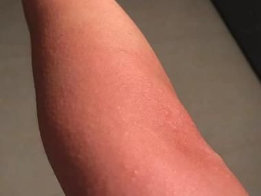 海鲜过敏症状怎么办_紧急处理步骤-第3张图片-山城妙识 海鲜过敏症状怎么办_紧急处理步骤-第3张图片-山城妙识