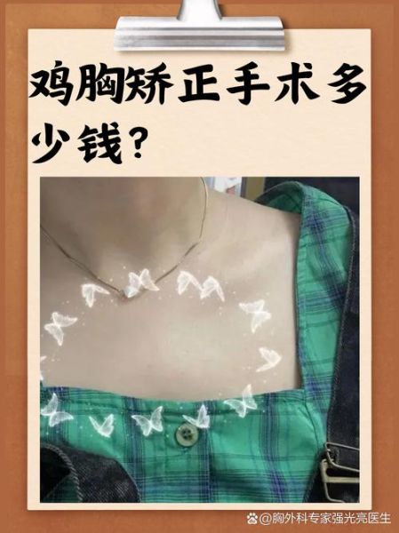 鸡胸病是什么_鸡胸病怎么矫正-第2张图片-山城妙识 鸡胸病是什么_鸡胸病怎么矫正-第2张图片-山城妙识