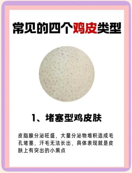 鸡皮肤是什么原因引起的_怎么改善鸡皮肤-第2张图片-山城妙识 鸡皮肤是什么原因引起的_怎么改善鸡皮肤-第2张图片-山城妙识