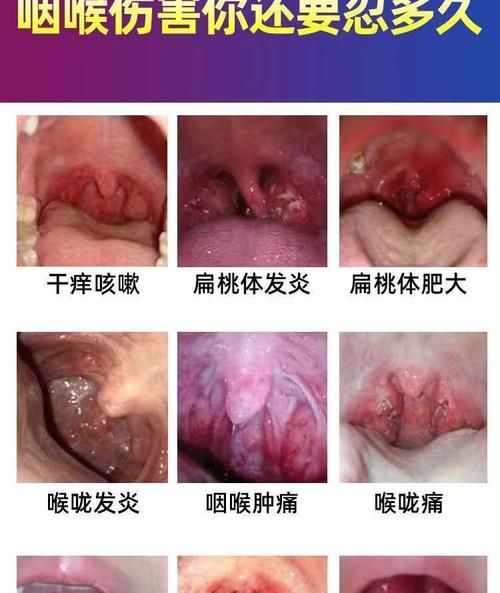 烟炎的症状有哪些_烟炎和咽喉炎区别-第2张图片-山城妙识 烟炎的症状有哪些_烟炎和咽喉炎区别-第2张图片-山城妙识