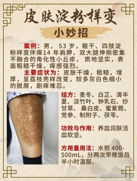 淀粉样变皮肤病最新治疗方法_能治好吗-第1张图片-山城妙识 淀粉样变皮肤病最新治疗方法_能治好吗-第1张图片-山城妙识