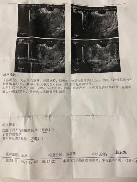 巧克力囊肿术后多久能怀孕_术后怀孕最佳时间-第3张图片-山城妙识 巧克力囊肿术后多久能怀孕_术后怀孕最佳时间-第3张图片-山城妙识