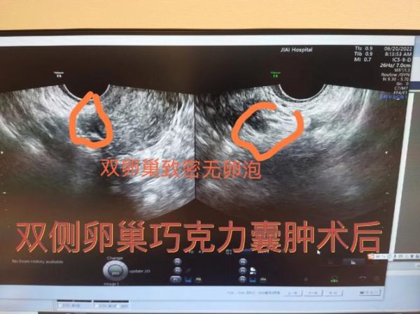 巧克力囊肿术后多久能怀孕_术后怀孕最佳时间-第2张图片-山城妙识 巧克力囊肿术后多久能怀孕_术后怀孕最佳时间-第2张图片-山城妙识