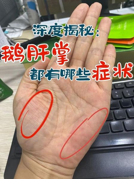 肝有病最明显的症状_肝病早期有哪些表现-第2张图片-山城妙识