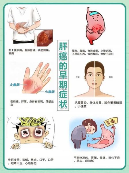 肝有病最明显的症状_肝病早期有哪些表现-第1张图片-山城妙识