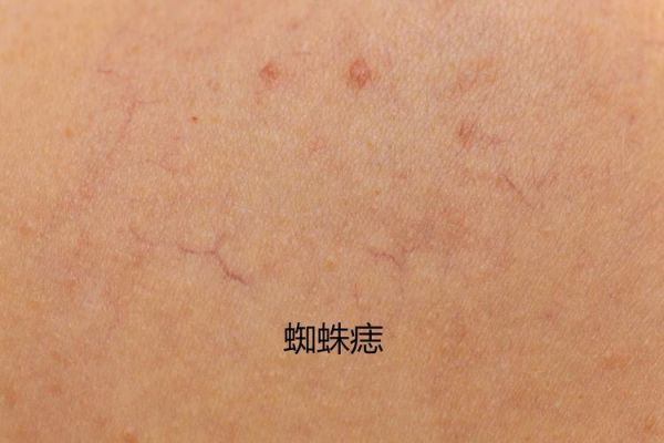 肝有病最明显的症状_肝病早期有哪些表现-第3张图片-山城妙识