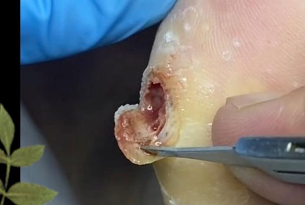 鸡眼挖出来后是什么样子_鸡眼根会一起掉吗-第1张图片-山城妙识 鸡眼挖出来后是什么样子_鸡眼根会一起掉吗-第1张图片-山城妙识