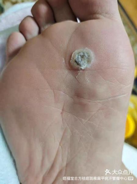 鸡眼挖出来后是什么样子_鸡眼根会一起掉吗-第3张图片-山城妙识 鸡眼挖出来后是什么样子_鸡眼根会一起掉吗-第3张图片-山城妙识
