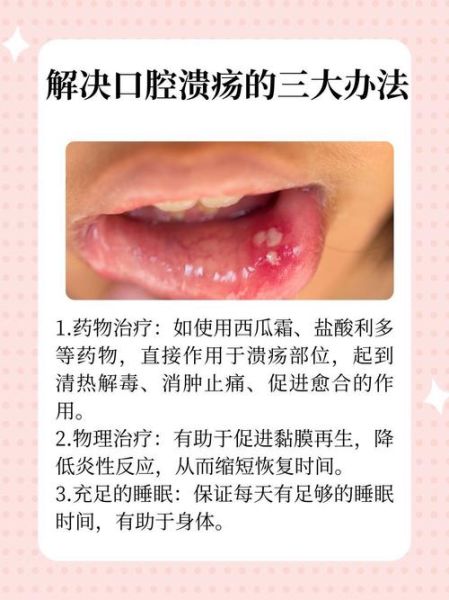 口腔溃疡几天能自愈_口腔溃疡多久能好-第1张图片-山城妙识 口腔溃疡几天能自愈_口腔溃疡多久能好-第1张图片-山城妙识