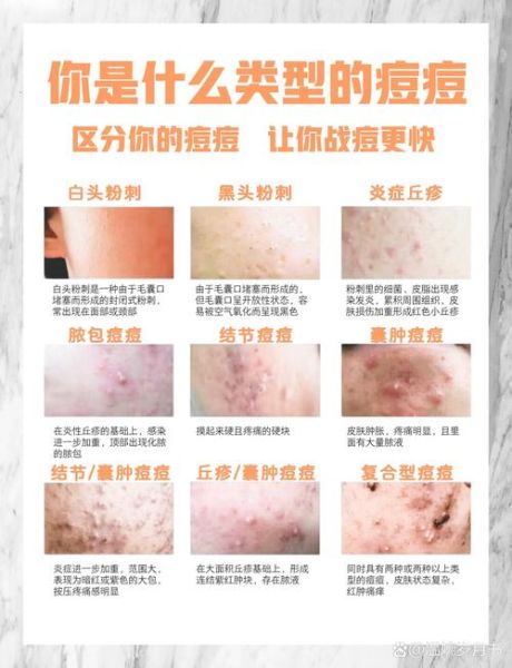 如何祛痘最有效_祛痘小妙招有哪些-第2张图片-山城妙识 如何祛痘最有效_祛痘小妙招有哪些-第2张图片-山城妙识