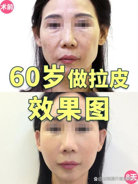 拉皮手术可以去除法令纹吗_拉皮手术去法令纹效果好吗-第1张图片-山城妙识 拉皮手术可以去除法令纹吗_拉皮手术去法令纹效果好吗-第1张图片-山城妙识