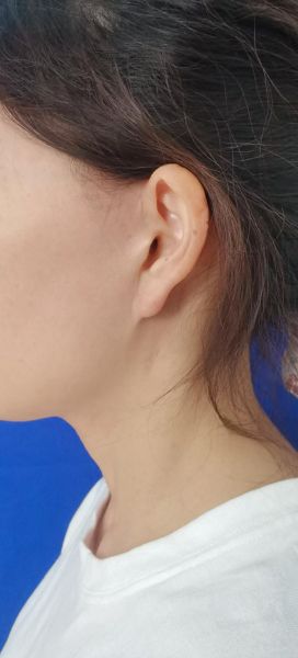 拉皮手术可以去除法令纹吗_拉皮手术去法令纹效果好吗-第3张图片-山城妙识 拉皮手术可以去除法令纹吗_拉皮手术去法令纹效果好吗-第3张图片-山城妙识