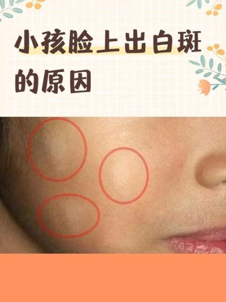 小孩脸上白斑缺维生素_白斑图片怎么判断-第1张图片-山城妙识 小孩脸上白斑缺维生素_白斑图片怎么判断-第1张图片-山城妙识