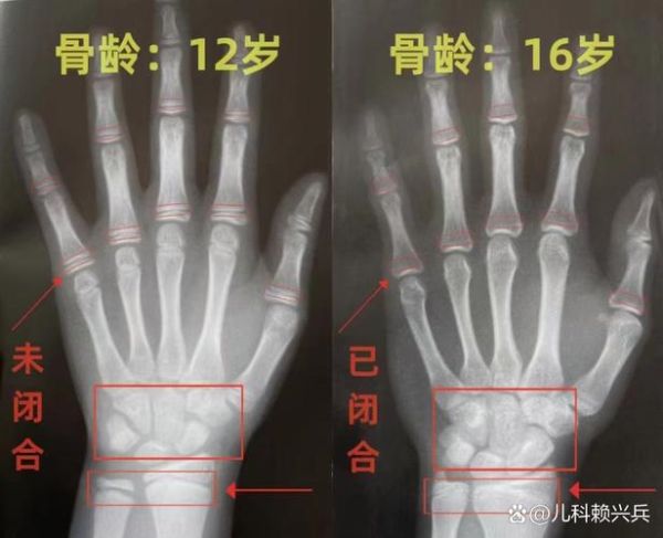 自测骨骼闭合小方法_骨骺线是否闭合怎么判断-第2张图片-山城妙识 自测骨骼闭合小方法_骨骺线是否闭合怎么判断-第2张图片-山城妙识
