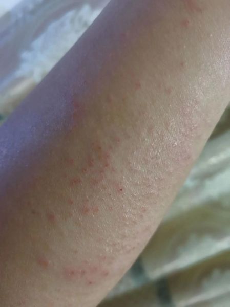 身上起红疙瘩越挠越痒_怎么办-第1张图片-山城妙识 身上起红疙瘩越挠越痒_怎么办-第1张图片-山城妙识