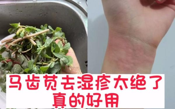 马齿苋治皮肤病怎么用_马齿苋外敷的正确方法-第3张图片-山城妙识 马齿苋治皮肤病怎么用_马齿苋外敷的正确方法-第3张图片-山城妙识