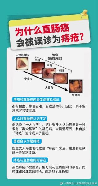 肠癌的早期症状有哪些_肠癌早期会疼吗-第3张图片-山城妙识 肠癌的早期症状有哪些_肠癌早期会疼吗-第3张图片-山城妙识