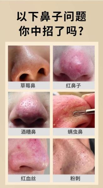 酒糟鼻怎么治才能治好_酒糟鼻用什么药膏最有效-第1张图片-山城妙识 酒糟鼻怎么治才能治好_酒糟鼻用什么药膏最有效-第1张图片-山城妙识