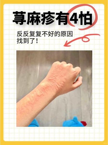荨麻疹可以自愈吗_荨麻疹多久能好-第2张图片-山城妙识 荨麻疹可以自愈吗_荨麻疹多久能好-第2张图片-山城妙识