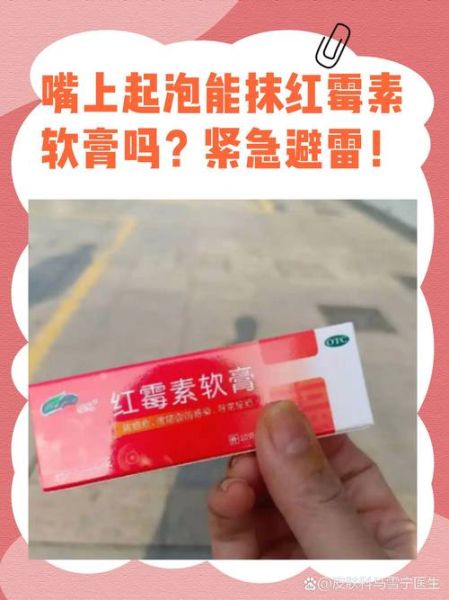 嘴角起泡用红霉素软膏有用吗_嘴角起泡怎么办-第2张图片-山城妙识 嘴角起泡用红霉素软膏有用吗_嘴角起泡怎么办-第2张图片-山城妙识