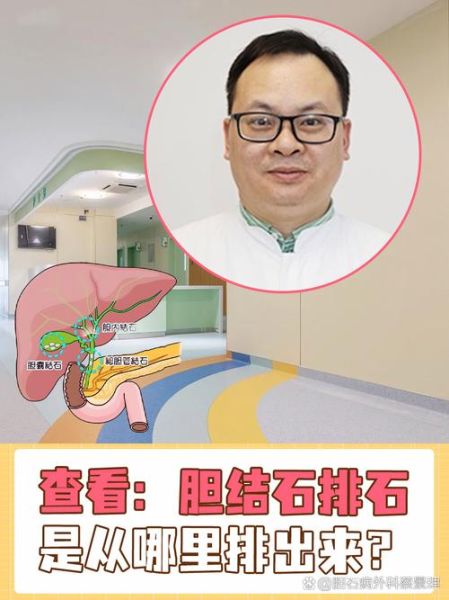 胆结石最佳排石方法_胆结石自然排石是真的吗-第1张图片-山城妙识 胆结石最佳排石方法_胆结石自然排石是真的吗-第1张图片-山城妙识