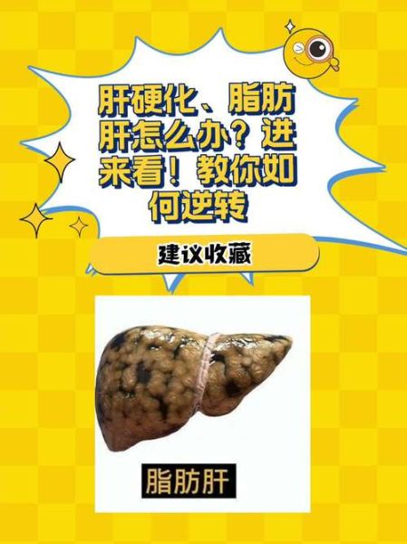 肝脂肪可以治疗吗_肝脂肪如何逆转-第1张图片-山城妙识 肝脂肪可以治疗吗_肝脂肪如何逆转-第1张图片-山城妙识