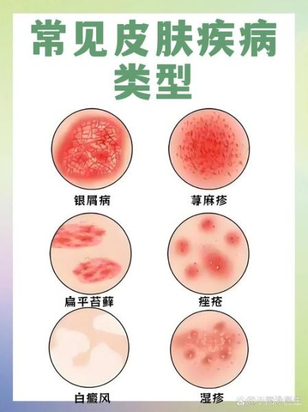 荨麻疹吃什么药好_荨麻疹止痒最快的方法-第3张图片-山城妙识 荨麻疹吃什么药好_荨麻疹止痒最快的方法-第3张图片-山城妙识