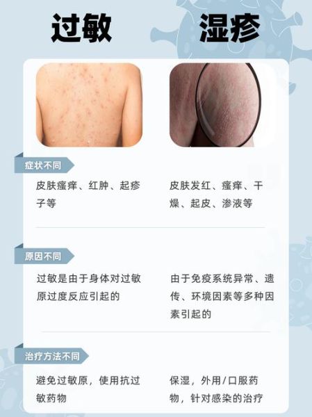 过敏性皮炎图片和症状_怎么判断是不是过敏性皮炎-第1张图片-山城妙识 过敏性皮炎图片和症状_怎么判断是不是过敏性皮炎-第1张图片-山城妙识