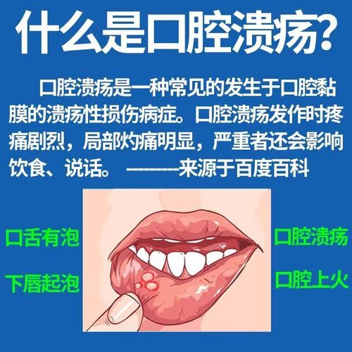 维生素b2治口腔溃疡多久见效_怎么吃最有效-第2张图片-山城妙识 维生素b2治口腔溃疡多久见效_怎么吃最有效-第2张图片-山城妙识