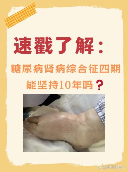 糖尿病严重吗_能活多久-第2张图片-山城妙识 糖尿病严重吗_能活多久-第2张图片-山城妙识