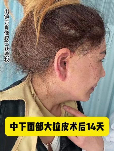 拉皮手术多久恢复自然_拉皮手术恢复期多久-第1张图片-山城妙识 拉皮手术多久恢复自然_拉皮手术恢复期多久-第1张图片-山城妙识